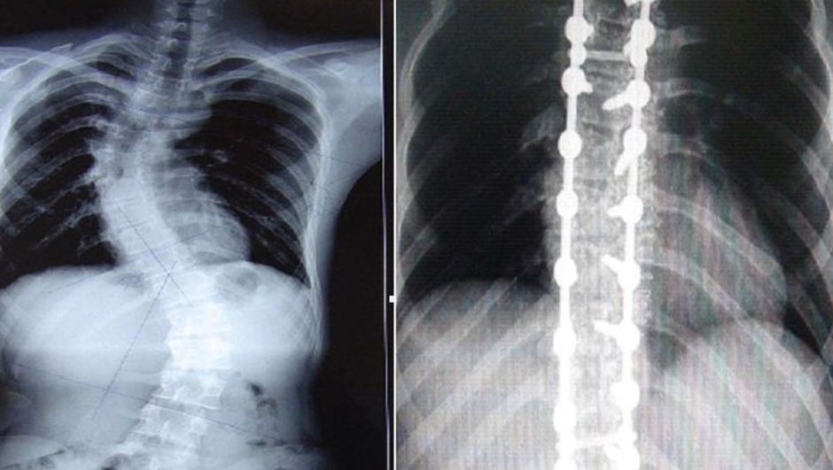 Skolyoz belirtileri nelerdir? | Sağlık Haberleri