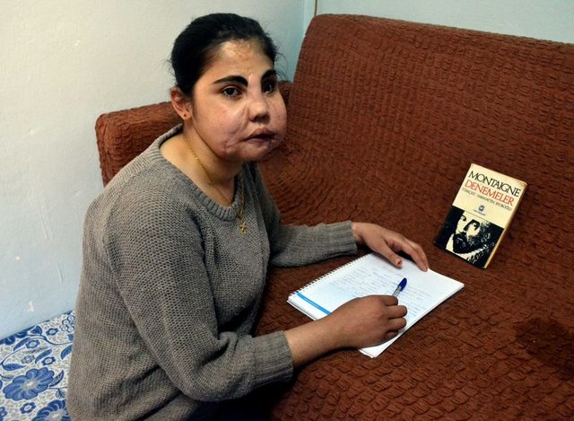 Türkiye'de yüz nakli olan ilk kadın Hatice Nergis öldü! | Sağlık Haberleri