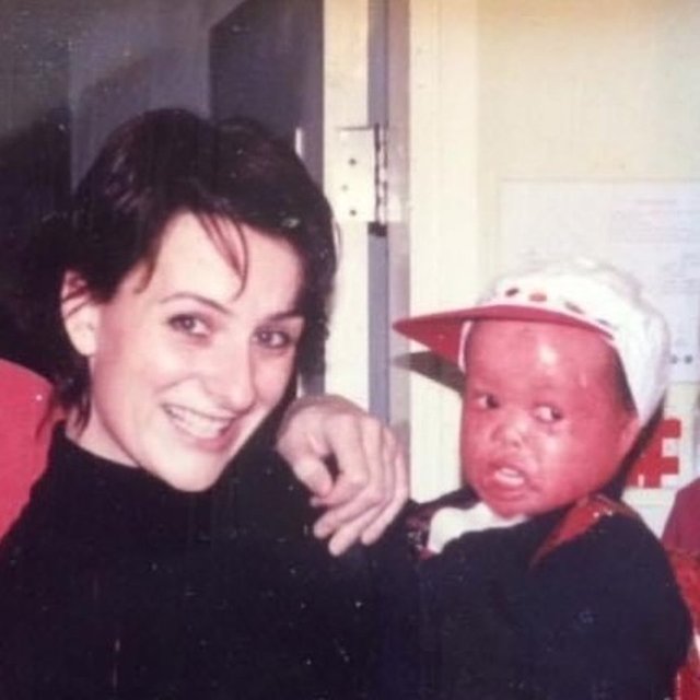 Hastalığı yüzünde terk edildi ama kendine bambaşka bir hayat yarattı!