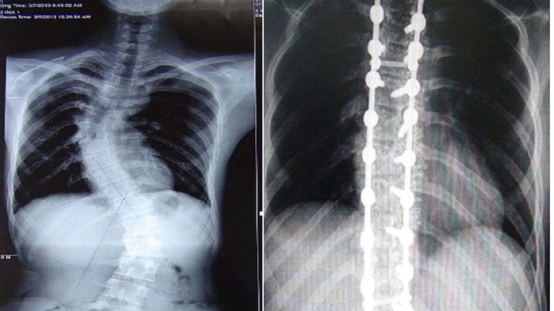 Skolyoz belirtileri nelerdir?