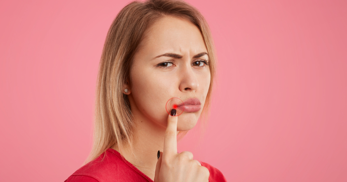 Uçuk neden olur? Uçuk nasıl geçer? Tedavisi nedir?