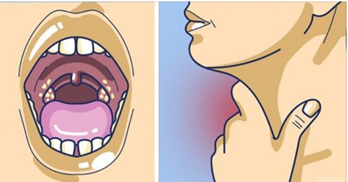 Faranjit nedir, faranjite ne iyi gelir, nasıl tedavi edilir? | Sağlık ...